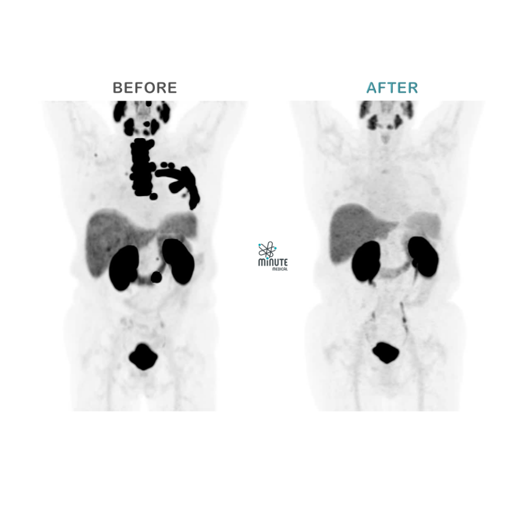 Koštane metastaze, rak prostate i teranostika - Minute Medical