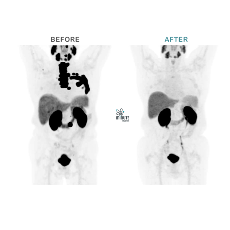 Knochenmetastasen, Prostatakrebs und Theranostik - Minute Medical